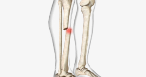 Tibia Fractures: Identify, Treat & Recover Safely